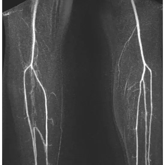 MRI Scan For MR Angiography Left Thigh | Medifyhome