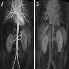 MRI Scan For MR Angiography Pelvis | Medifyhome
