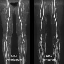 MRI Scan For MR Bilateral Lower Limb Angiography | Medifyhome