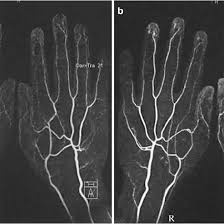 MRI Scan For MR Right Hand Angiography | Medifyhome