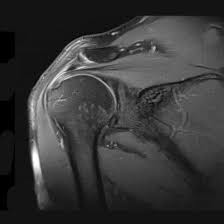 MRI Both Shoulder Joints | Medifyhome