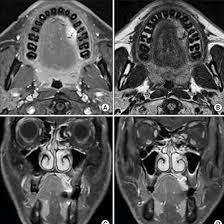 MRI For Cheek Scan | Medifyhome