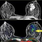 MRI Scan For Left Breast | Medifyhome