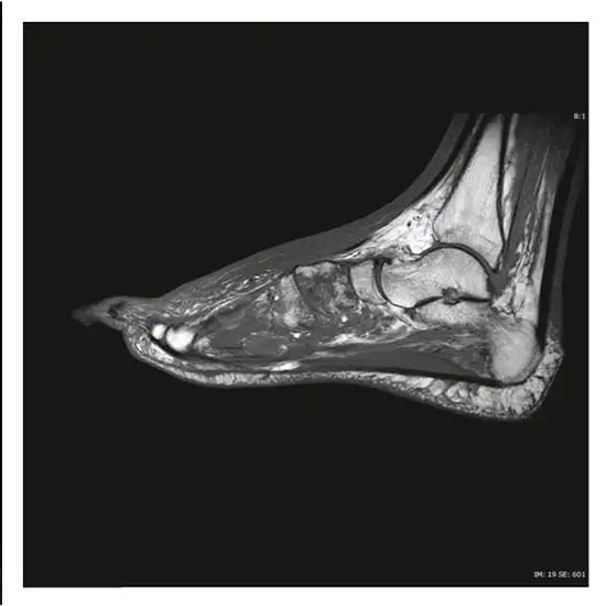 MRI Scan For Left Foot With Contrast | Medifyhome