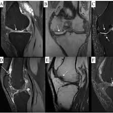 MRI Scan For Left Knee With Cartigram | Medifyhome