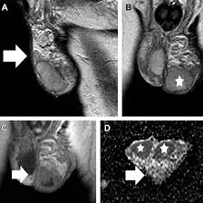 MRI Scan For Left Testis | Medifyhome