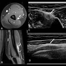 MRI Scan For Left Radial Nerve | Medifyhome