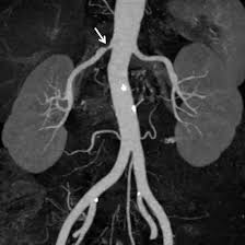 MRI of the Renal Angiography | Medifyhome