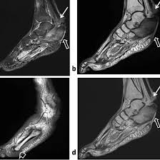 MRI For Right Foot With Contrast | Medifyhome