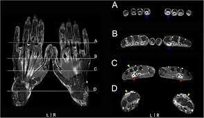 MRI Screening Bilateral Hands | Test price | Medifyhome
