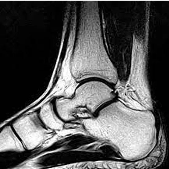 MRI Screening Of Ankle Joint | Affordable price | Medifyhome