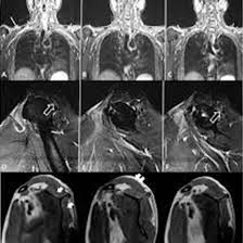 MRI Screening Right Parascapular | Medifyhome