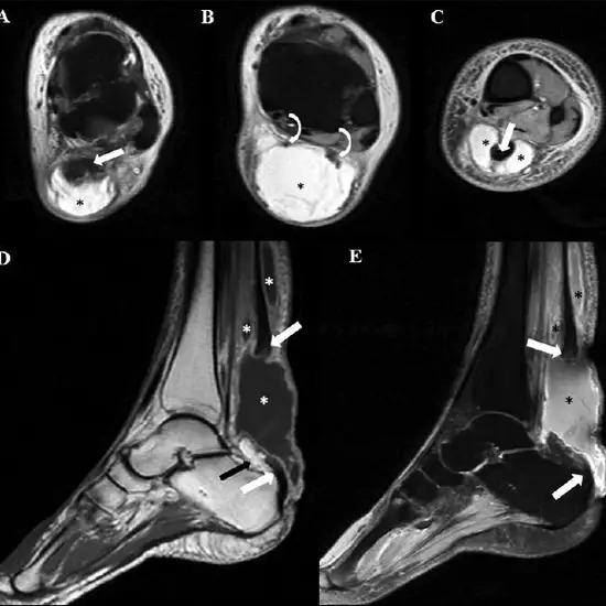MRI Scan For Left Ankle With Cartigram | Medifyhome