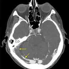 NCCT Mastoid | Test cost | Medifyhome