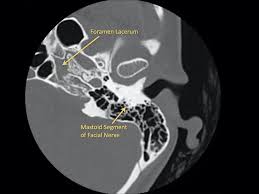 NCCT Temporal Bone Axial | Test price | Medifyhome
