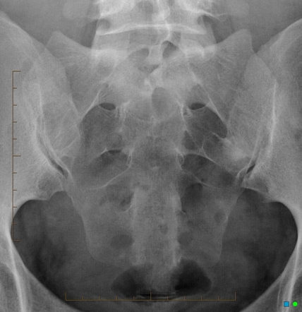 Sacroiliac Joint Xray Positioning