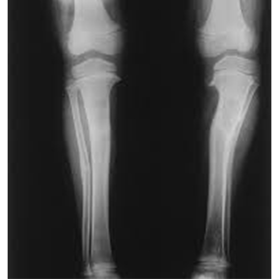 X-Ray Exam : Lower Leg (Tibia and Fibula) | Medifyhome