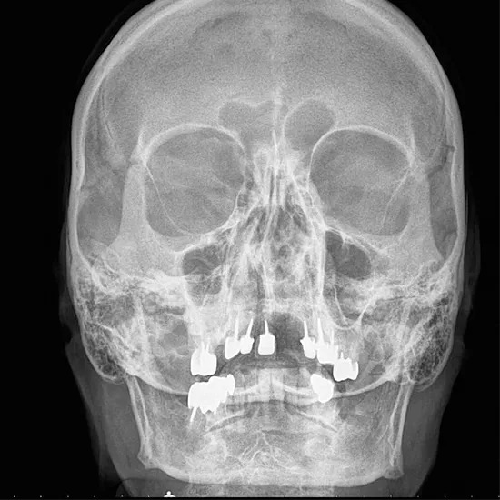 Nasal Bone Anatomy X Ray Normal Nasal Bone X Ray Gallery