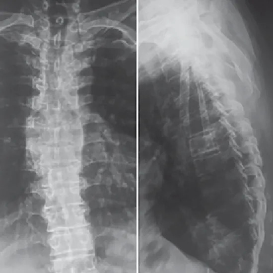 X-Ray Thoracic Lumbar (AP/LAT) View | Medifyhome