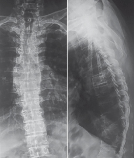 Lumbar Spine X Ray Views