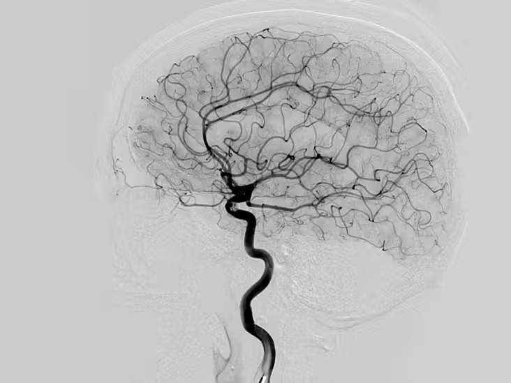 MRA Brain Procedure | Medifyhome