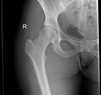 X-Ray Left Femur | Medifyhome