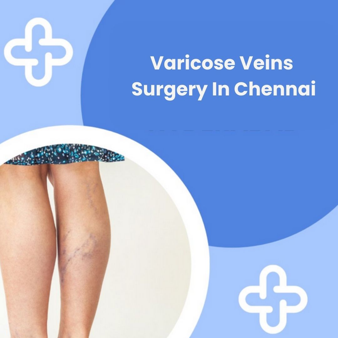 Varicose Veins Surgery in Chennai | Medifyhome