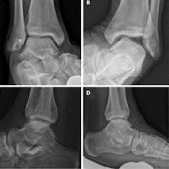 X-Ray Bilateral Heel AP and Lateral View | Book Now!