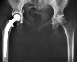 X-ray Both Upper Femur-Hip AP/Lat | Medifyhome