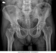 X-ray Both HIP AP and LAT | Medifyhome