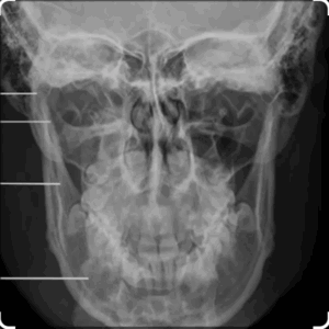 X-ray Mandible PA View | Medifyhome