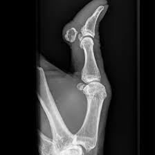 X-ray Left Thumb AP and LATERAL | Medifyhome