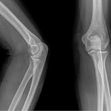 X-Ray Right Elbow AP and Lateral | Medifyhome