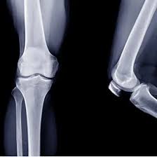 X-Ray Left Knee AP and Lateral | Medifyhome
