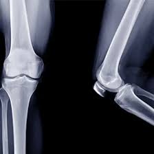 X-Ray Right Patella AP and Lateral | Medifyhome